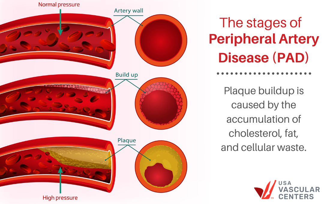 What Is Arterial Plaque? - PAD Treatment Centers | USA Vascular Centers