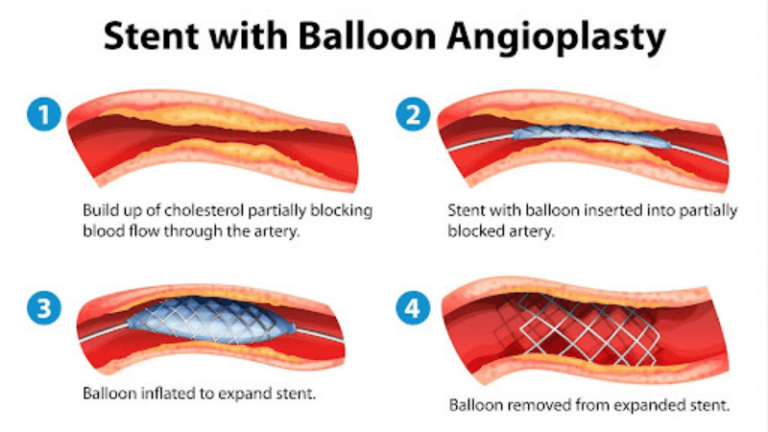 Types of Stents for Peripheral Artery Angioplasty