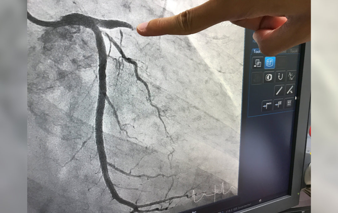 What is an Angiogram? - PAD Treatment Centers | USA Vascular Centers