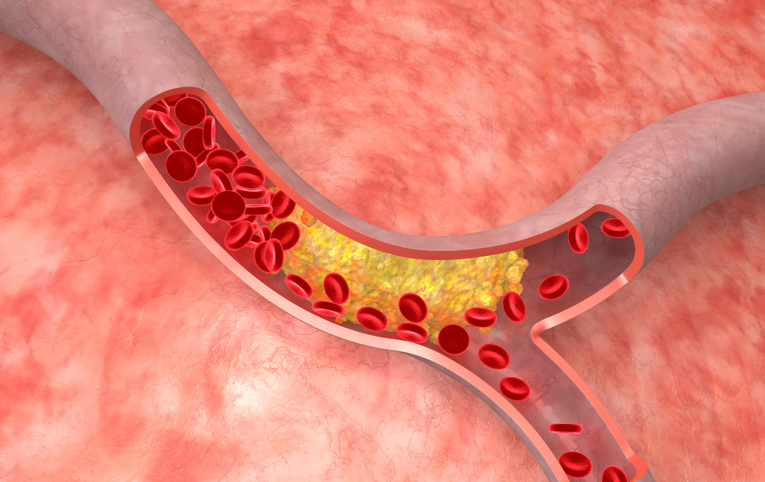 What is an Angiogram? - PAD Treatment Centers | USA Vascular Centers