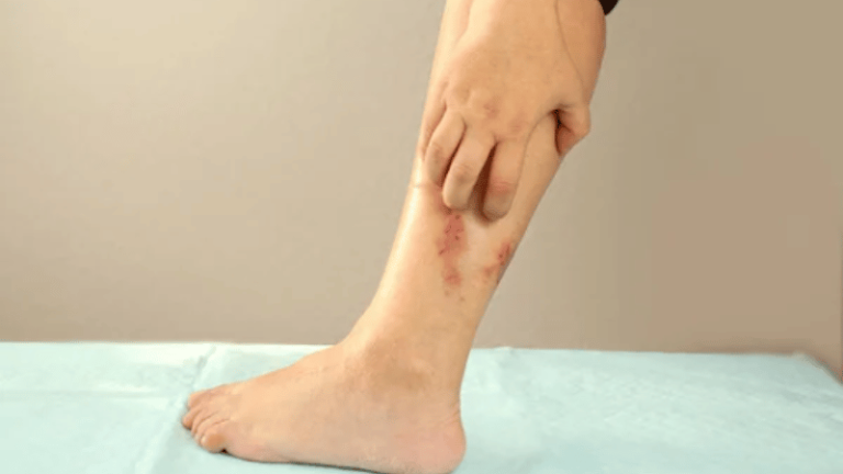What Do Slow-Healing Leg Wounds On Legs Mean?