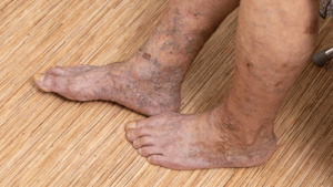 What Do Slow-Healing Leg Wounds On Legs Mean?