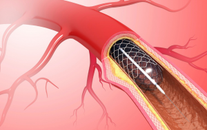 What Is Arterial Revascularization? | USA Vascular Centers