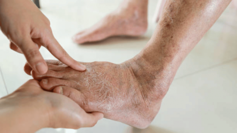 Skin Changes Linked to Peripheral Artery Disease