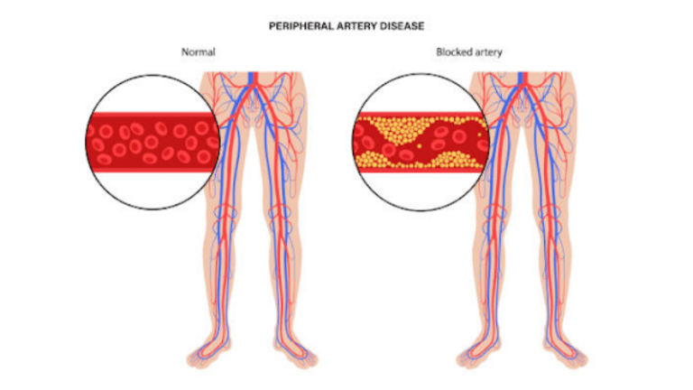 Calcification and Peripheral Artery Disease