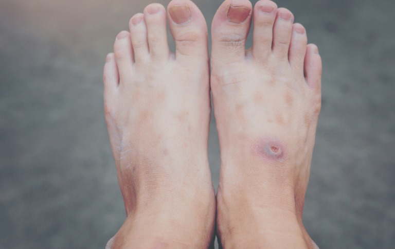 Peripheral Artery Disease Treatment | USA Vascular Centers