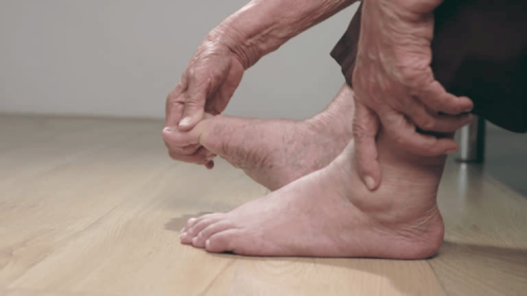 10 Reasons Why You May Have Swollen Legs or Feet