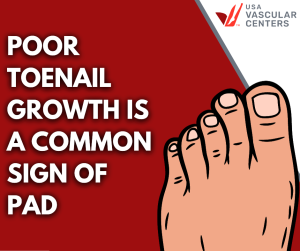 Why Are My Toenails Not Growing | USA Vascular Centers