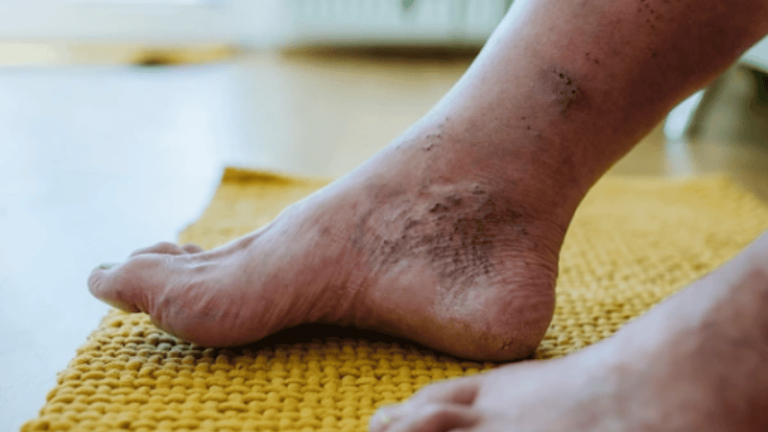 Why Are My Feet Turning Blue?