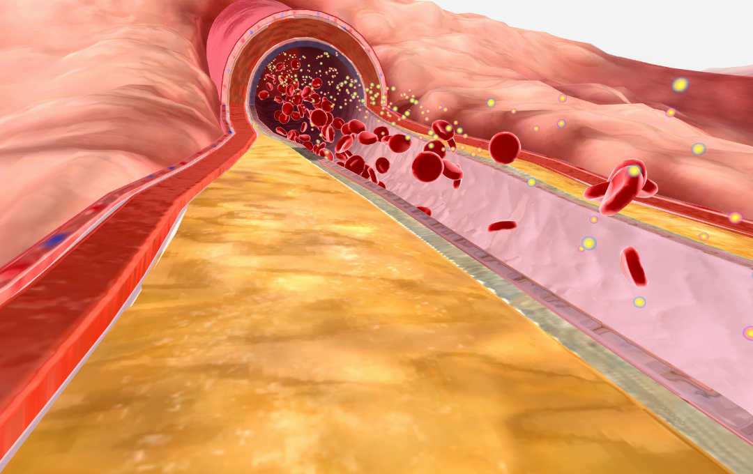 National Vascular Disease Awareness Month - PAD Treatment Centers | USA ...