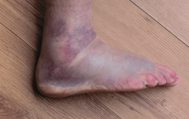 Causes of Purple Feet in Adults