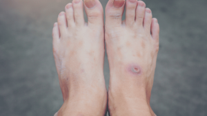 Causes of Purple Feet in Adults