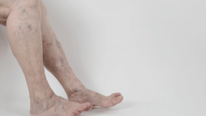 Causes of Purple Feet in Adults