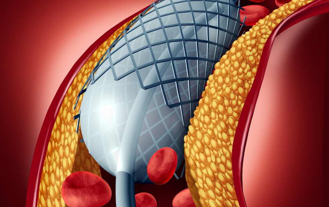 What Is the Best Treatment for Peripheral Artery Disease? - PAD ...